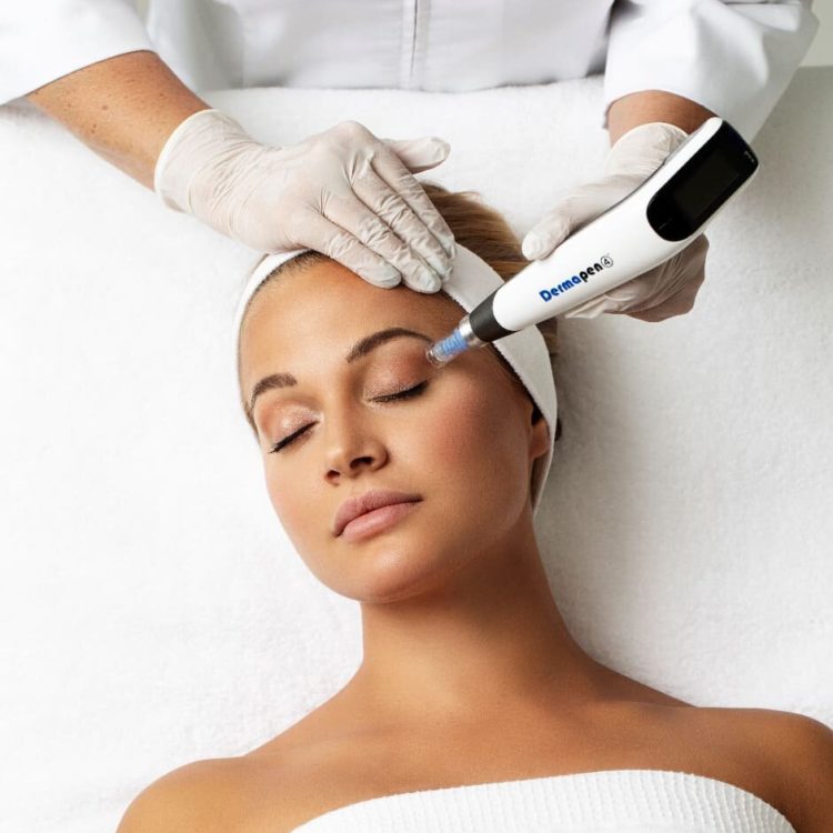 MicroNeedling Dermapen 4 Behandeling in Eindhoven | Annie Verhoeven ...